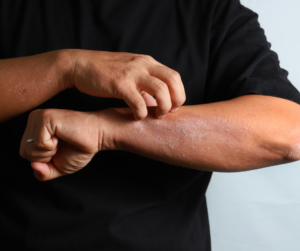 Understanding and Treating Eczema - Skin Center